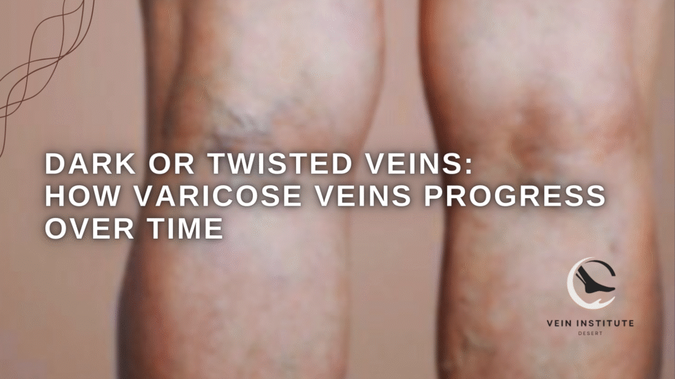 Dark or Twisted Veins: How Varicose Veins Progress Over Time