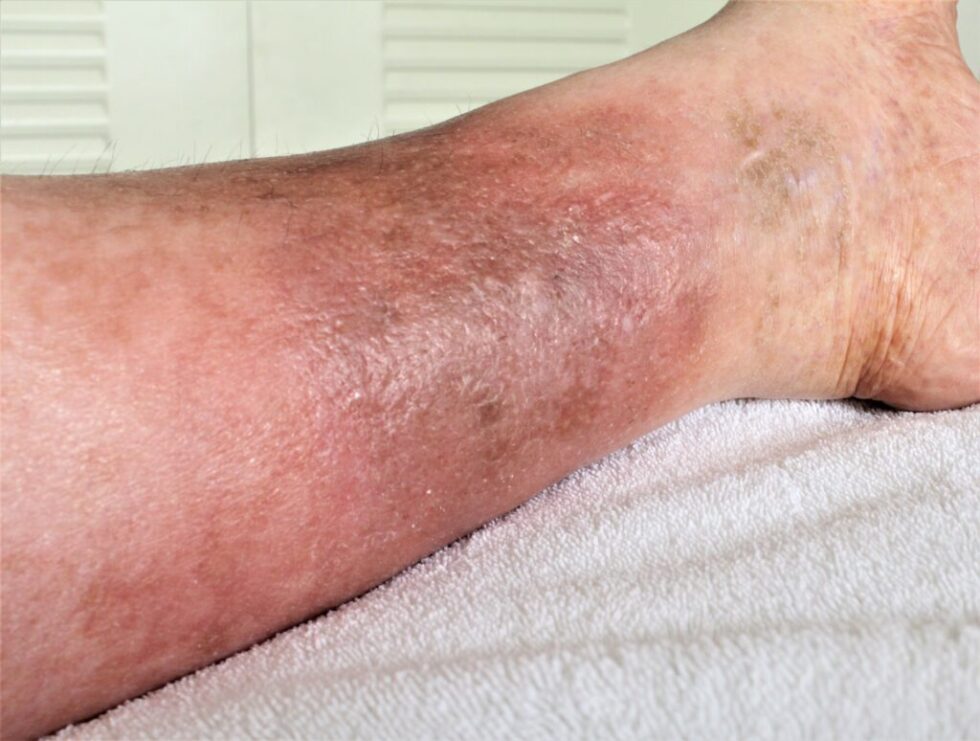 Chronic Venous Insufficiency in Hot Climates: What Patients Miss