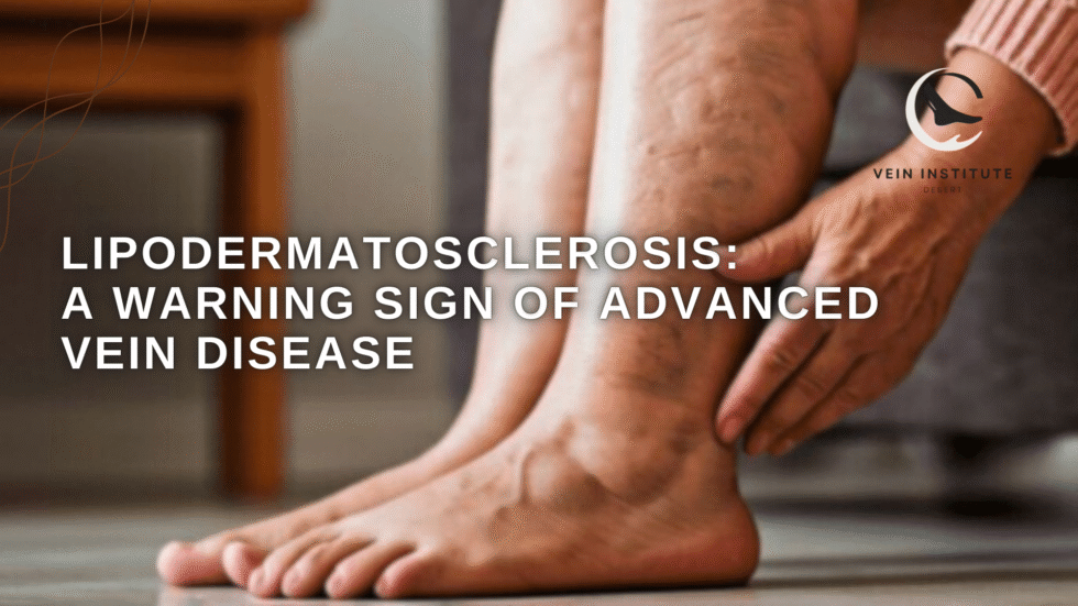 Lipodermatosclerosis: A Warning Sign of Advanced Vein Disease